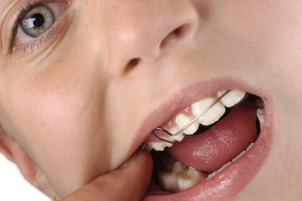 Why Cleaning and Caring For A Retainer Is Important